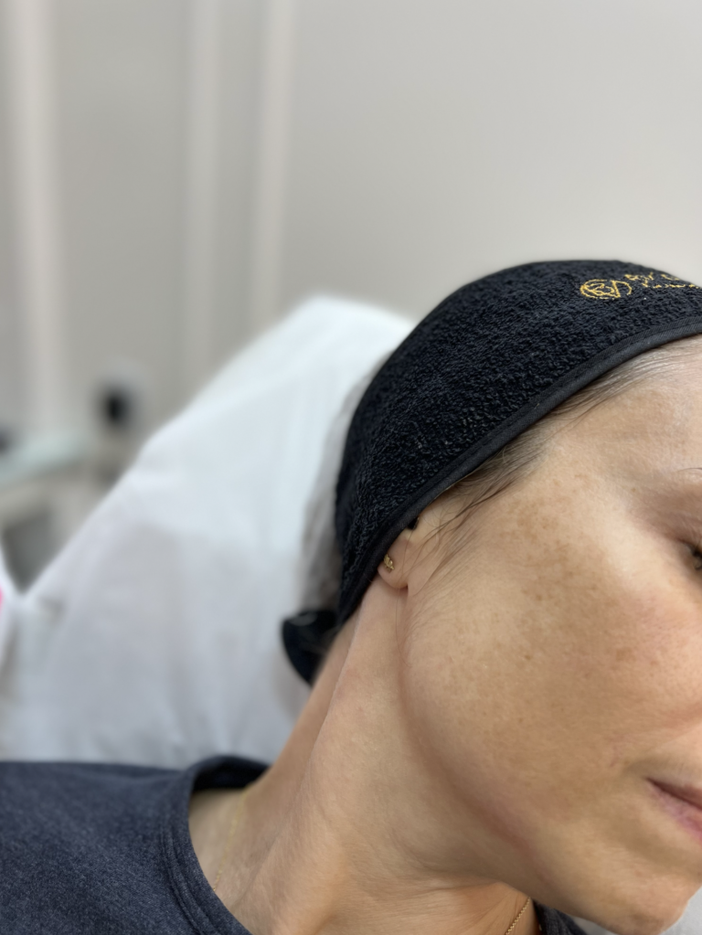 Você tem melasma? Veja como usar o filtro solar para se proteger! - BV ...
